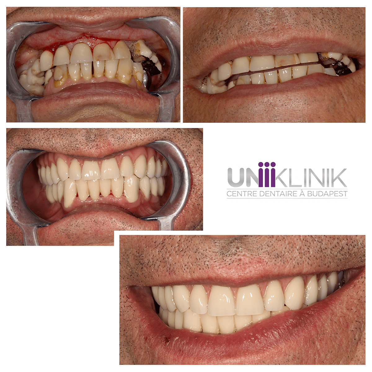 Solution semi-fixe : prothèse sur barre de rétention - UNIKLINIK ...